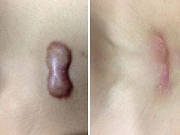 Keloid Treatment Locations | Doctor Keloid