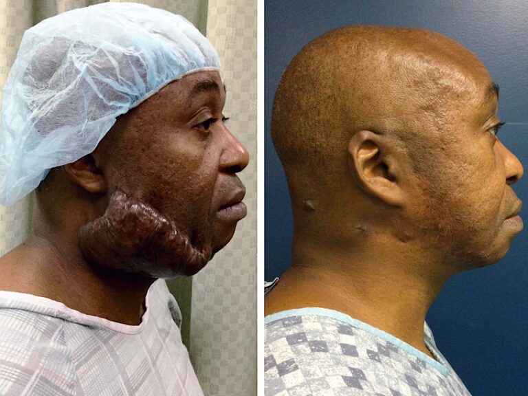 #1 Keloid Specialists & Scar Removal Expert | Doctor Keloid